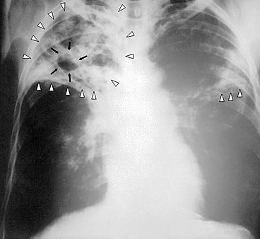 Tuberculosis – Tuberculosis